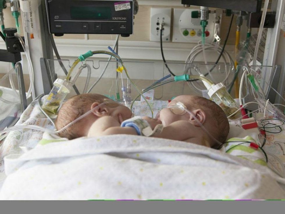Conjoined twins survive miraculous surgery at Medical City Children's ...